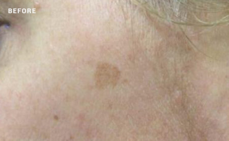 Dark & Age Spots Treatments For Men Vancouver | NuAGE Laser