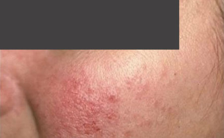 IPL Photofacial for Rosacea/Rosy Cheeks | Vancouver | NuAGE Laser