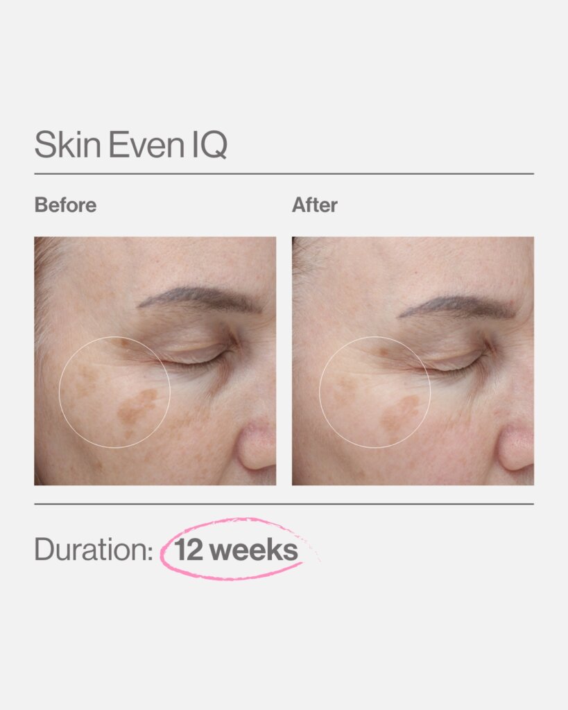 Skin Even IQ - NuAGE Laser